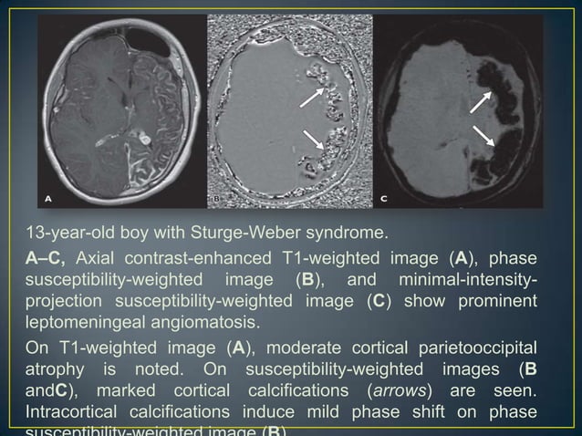 Susceptibility Weighted Imaging (SWI) | PPT