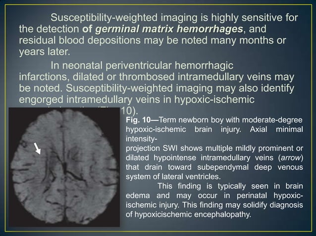 Susceptibility Weighted Imaging (SWI) | PPTX