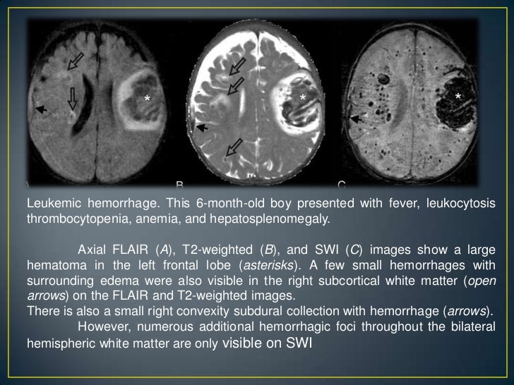 Susceptibility Weighted Imaging (SWI)