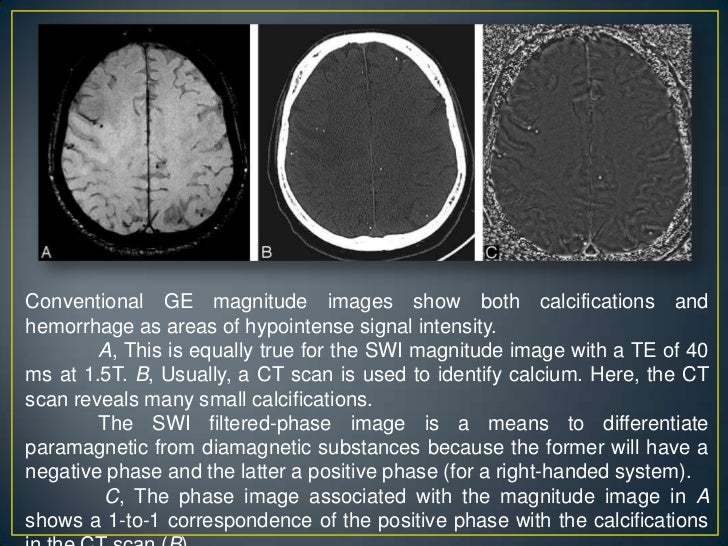 Susceptibility Weighted Imaging (SWI)