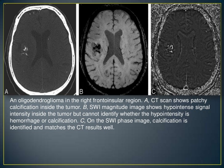 Susceptibility Weighted Imaging (SWI)
