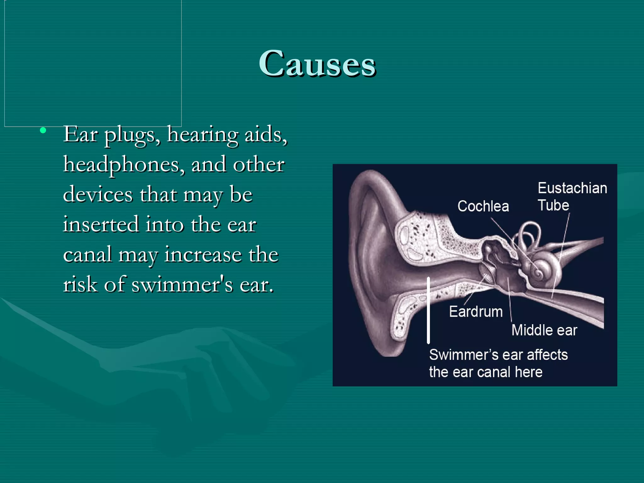 Swimmer’s ear roberto | PPT
