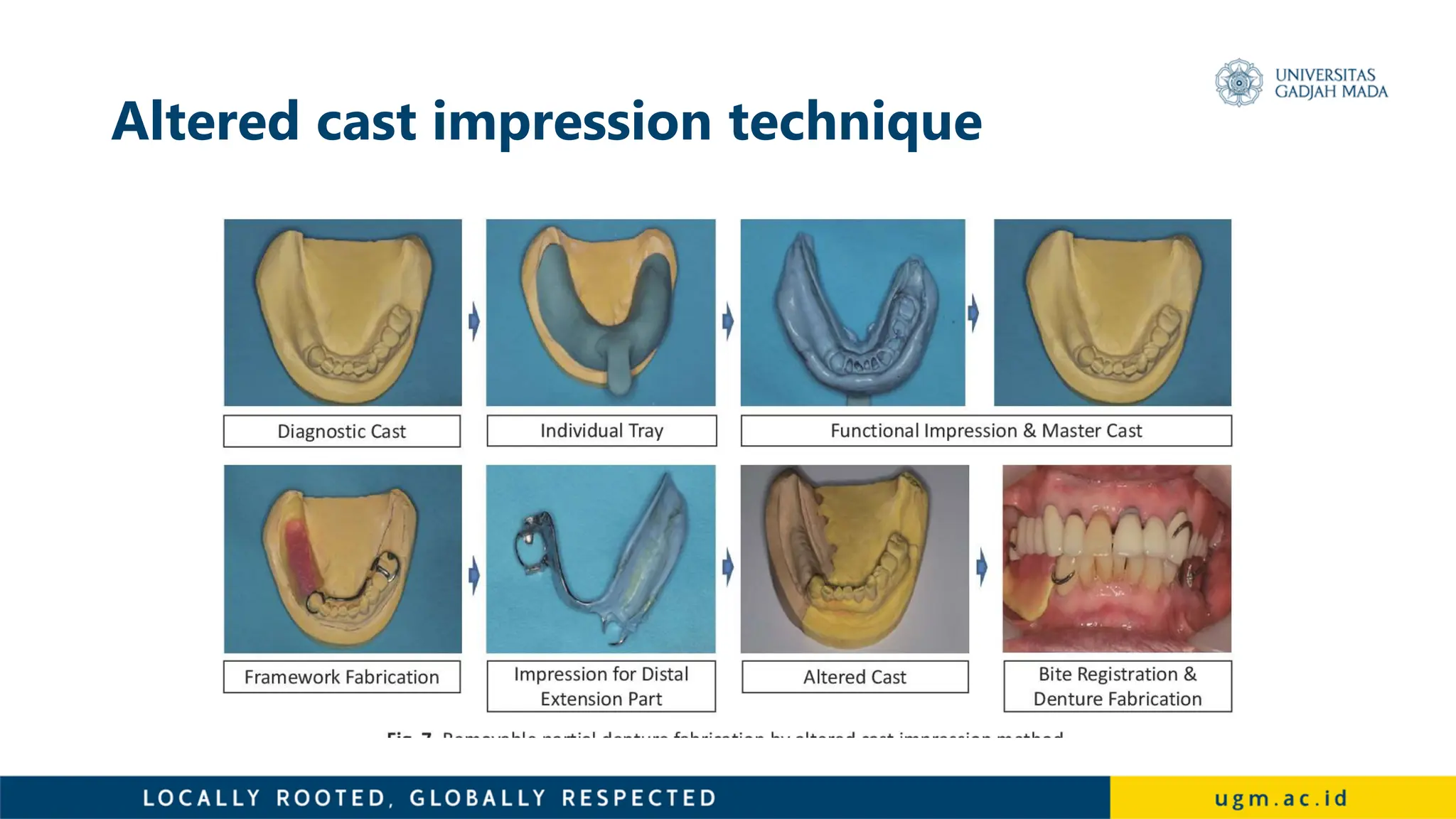 Swinglock Gigi Tiruan Sebagian Kerangka Logam | PPTX