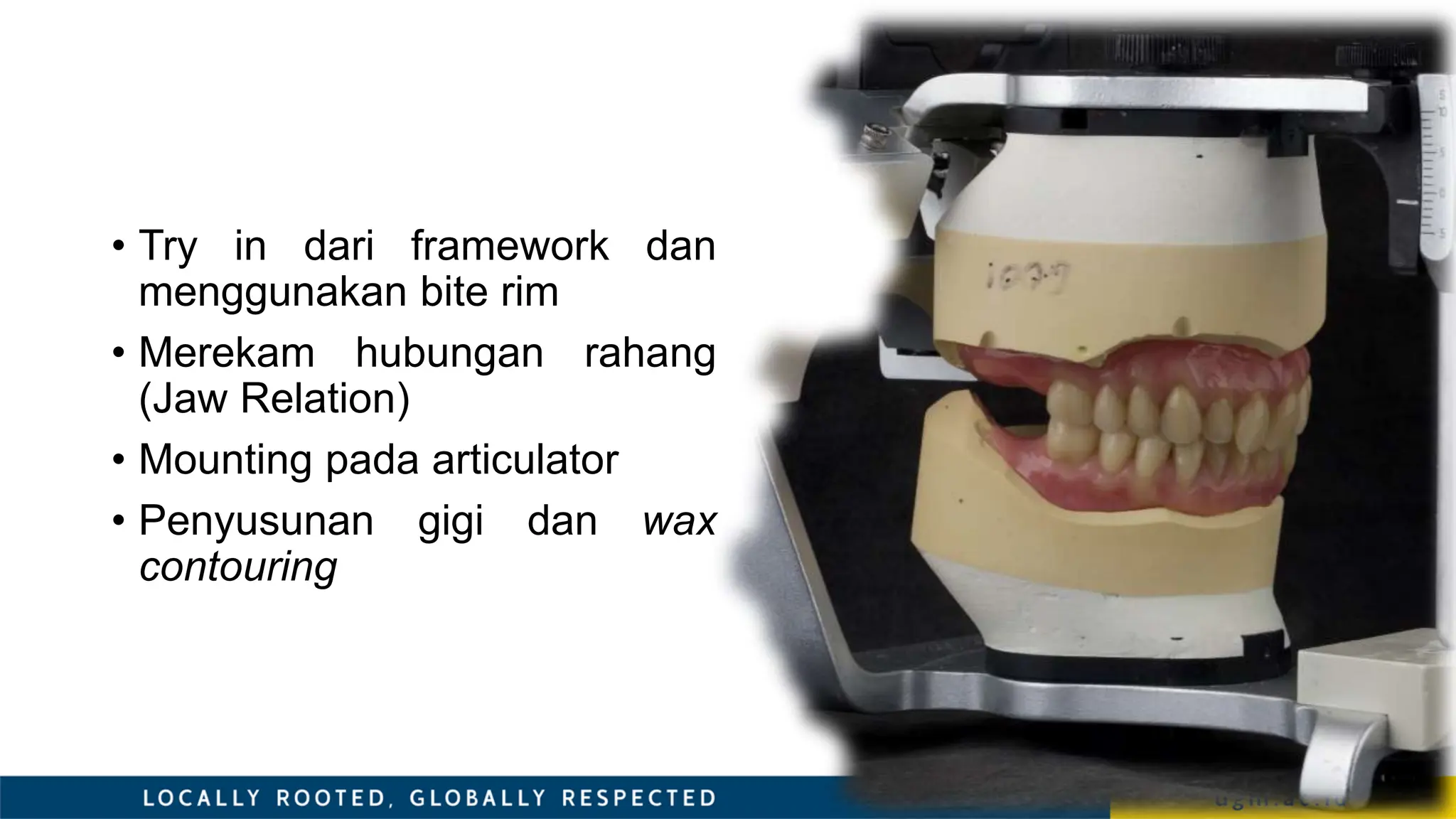 Swinglock Gigi Tiruan Sebagian Kerangka Logam | PPTX