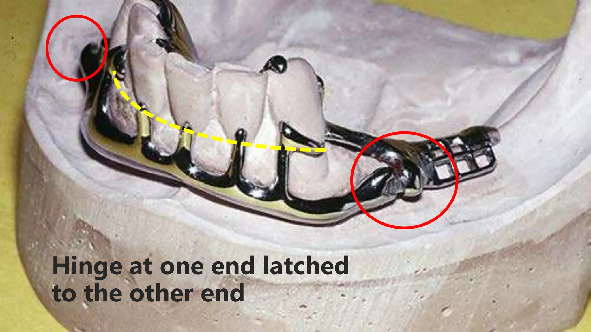 Swinglock Gigi Tiruan Sebagian Kerangka Logam | PPTX