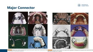 Swinglock Gigi Tiruan Sebagian Kerangka Logam | PPTX