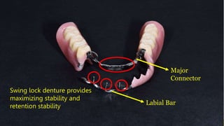 Swinglock Gigi Tiruan Sebagian Kerangka Logam | PPTX