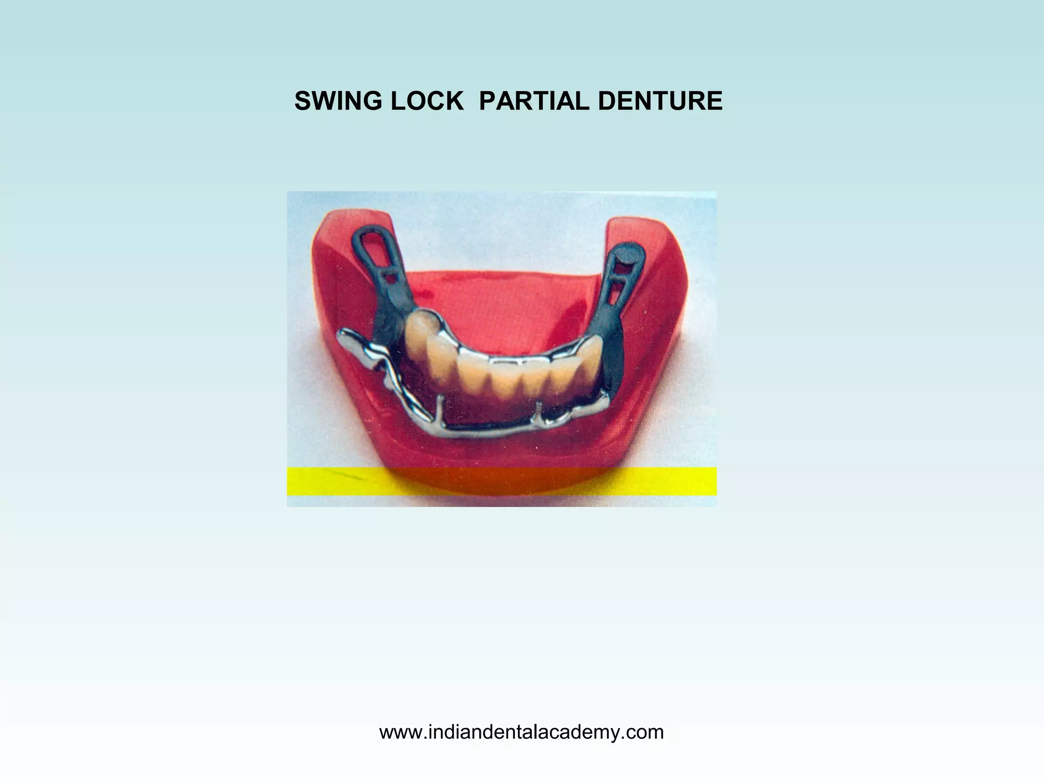 Swing lock partial denture/ oral surgery courses | PPT