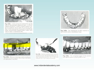 Swing lock partial denture/ oral surgery courses | PPT