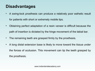 Swing lock partial denture/ oral surgery courses | PPT