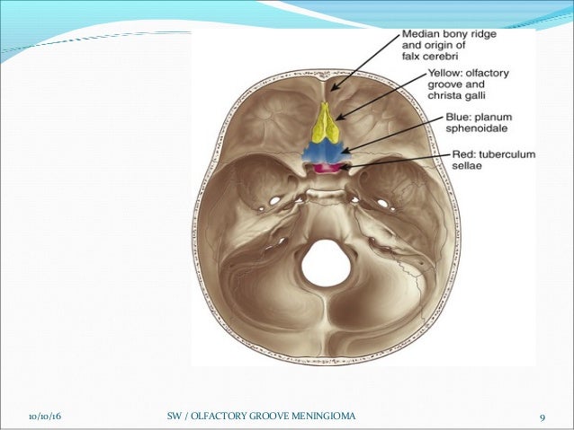 sphenoid wing meningiomas