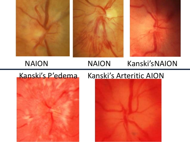 Swollen optic nerve_presentation_last_revision 103112 disregard all o…
