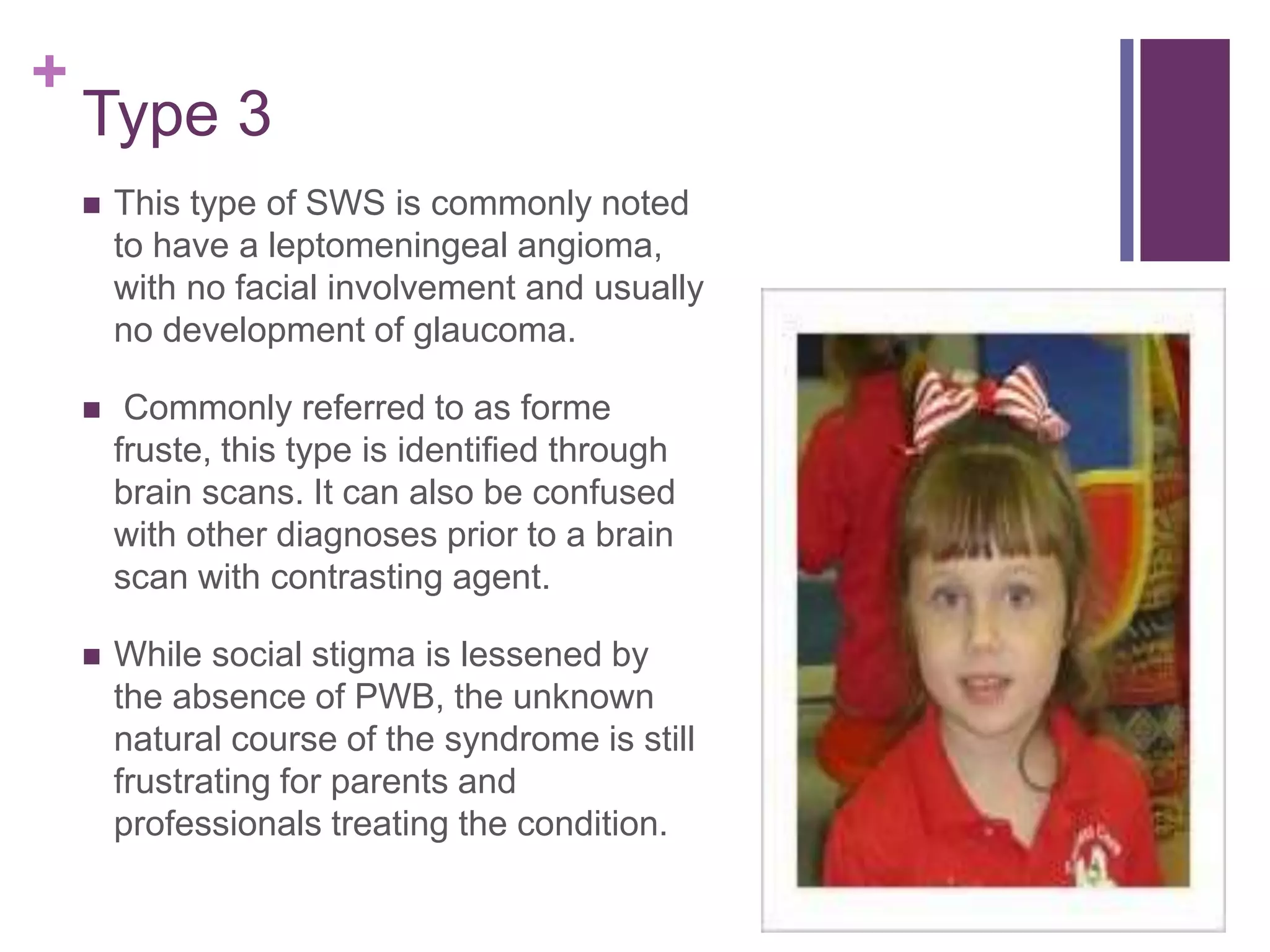 Sturge weber syndrome | PPTX
