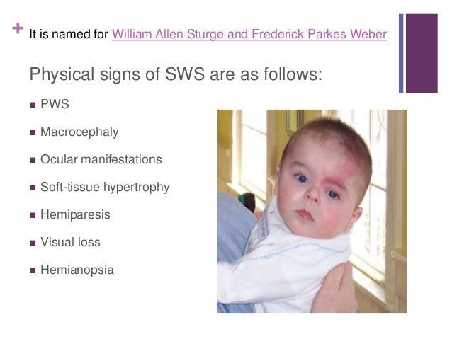 Sturge weber syndrome