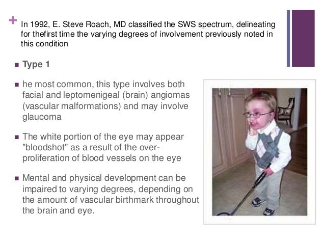 Sturge weber syndrome