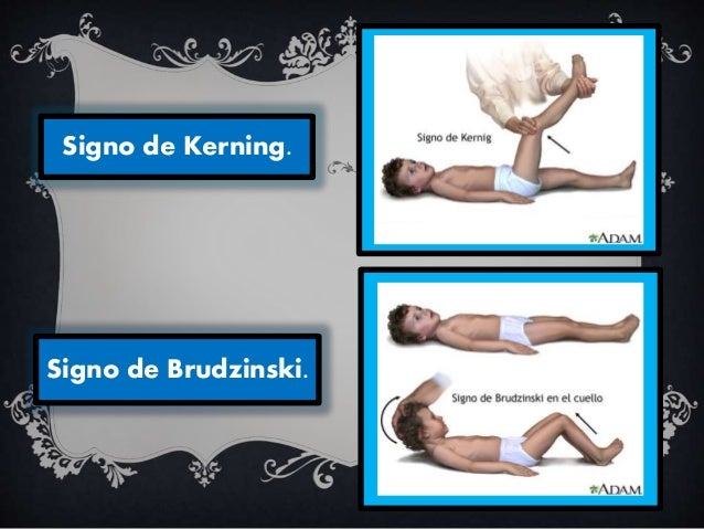 Sx.convulsivo. Sx. Meningeo.