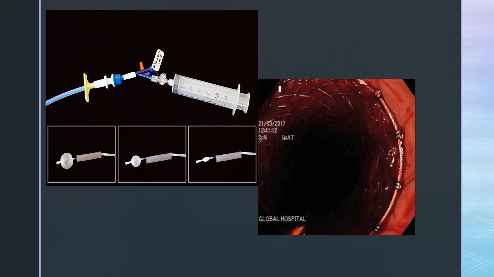 SX-Ella Danis stent in massive upper gastrointestinal bleeding.pptx