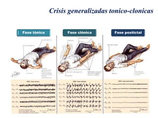 Sindrome convulsivo en pediatria | PPTX