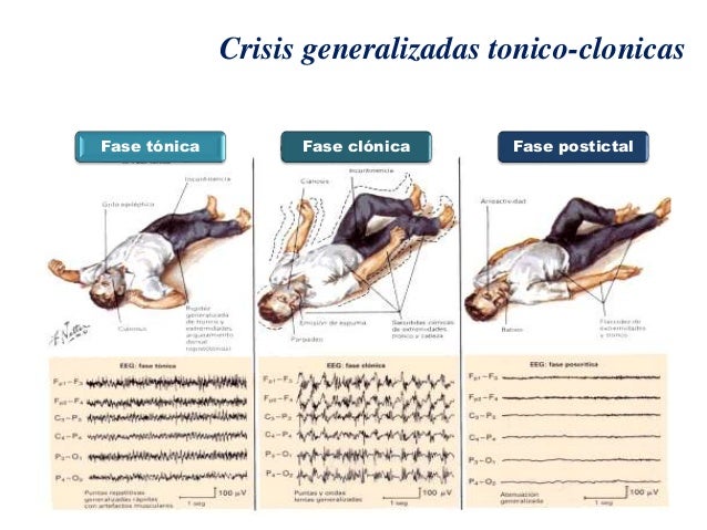 Sindrome Convulsivo En Pediatria