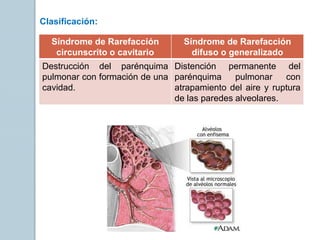 Sx de rarefaccion | PPT