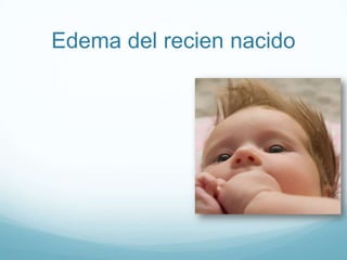 Diapositivas de Sindrome Edematoso, Dr. espinosa | PPTX