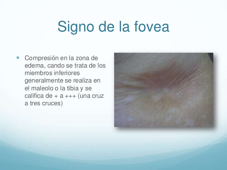 Diapositivas de Sindrome Edematoso, Dr. espinosa
