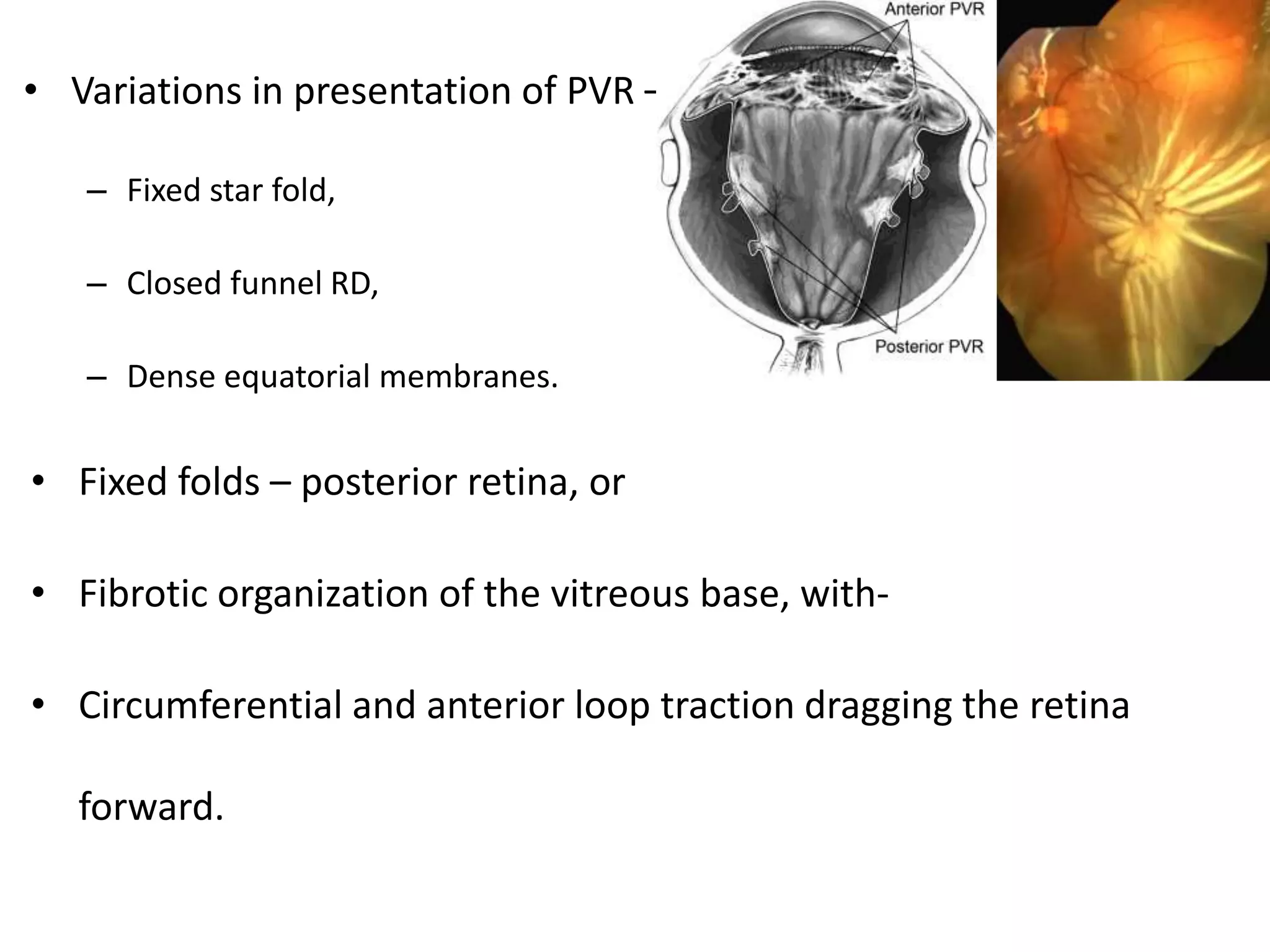 Surgical management of Proliferative Vitreoretinopathy | PPTX | First ...