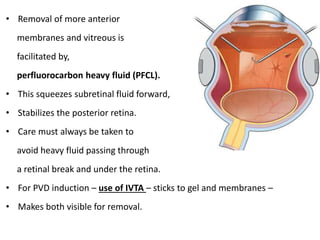 Surgical management of Proliferative Vitreoretinopathy | PPTX | First ...