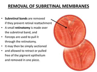 Surgical management of Proliferative Vitreoretinopathy | PPTX