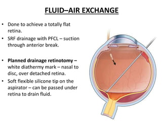 Surgical management of Proliferative Vitreoretinopathy | PPTX | First ...