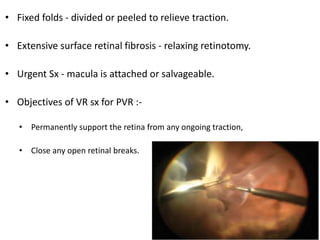 Surgical management of Proliferative Vitreoretinopathy | PPT