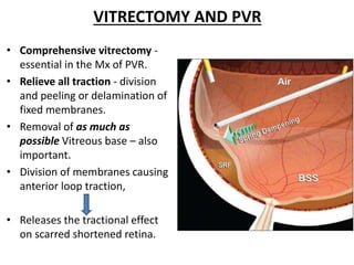 Surgical management of Proliferative Vitreoretinopathy | PPT