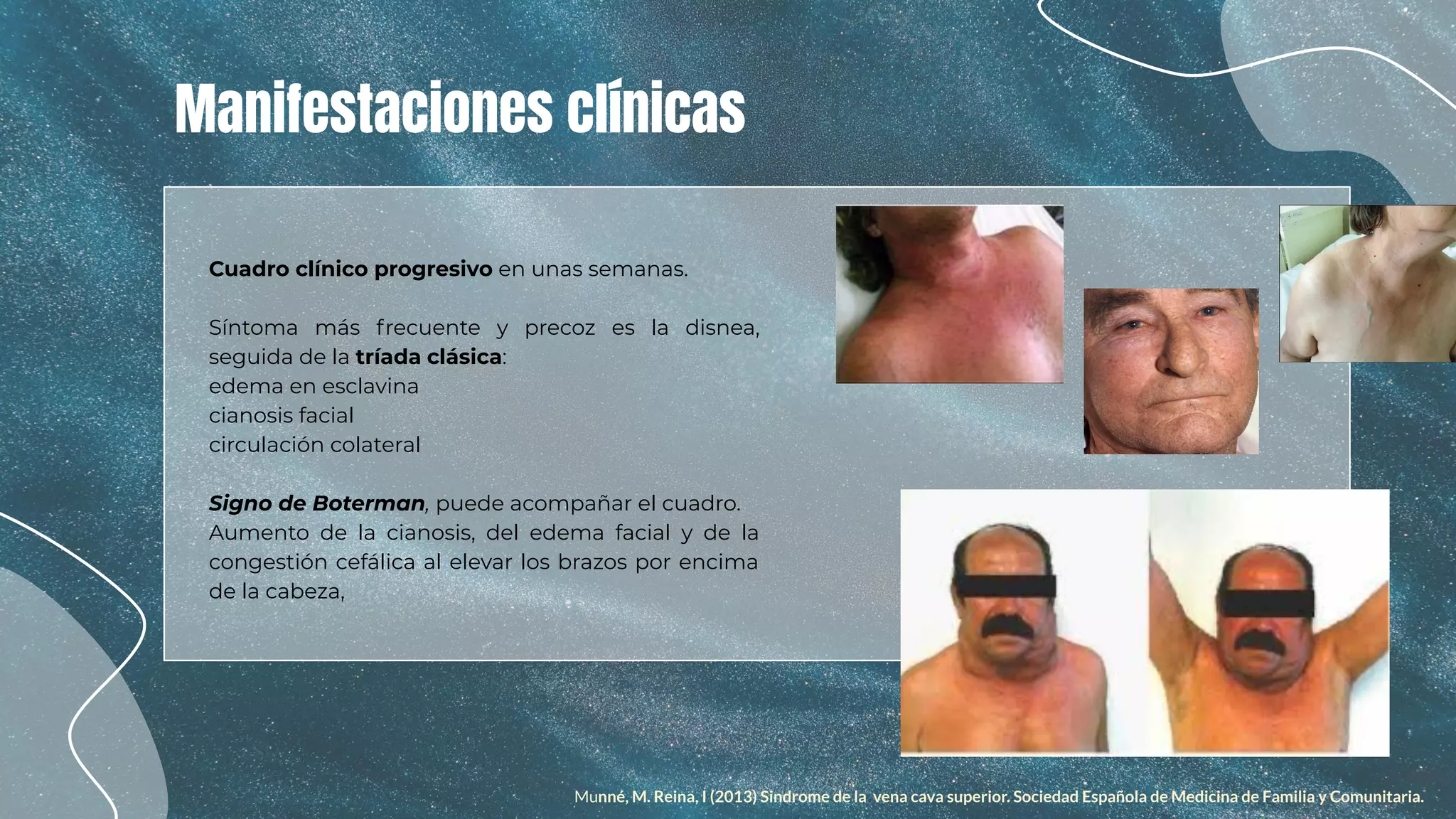 Sindrome vena cava superior | PDF