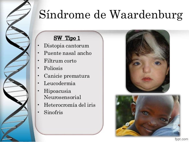 Síndrome de Waardenburg