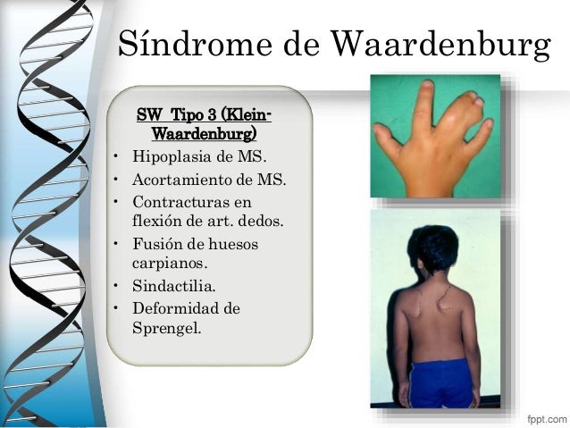Síndrome de Waardenburg