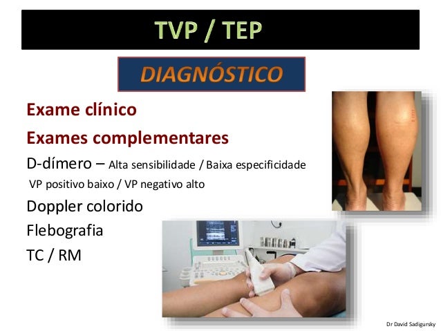 Aula Trombose Venosa Profunda (TVP) - Ortopedia
