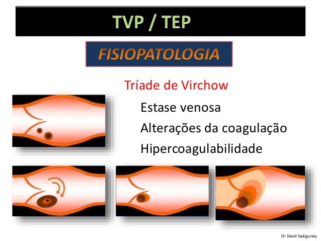 Aula Trombose Venosa Profunda (TVP) - Ortopedia