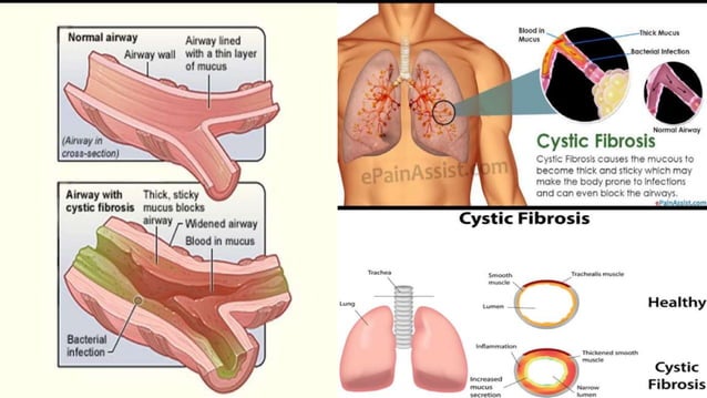 cystic fibrosis | PPT