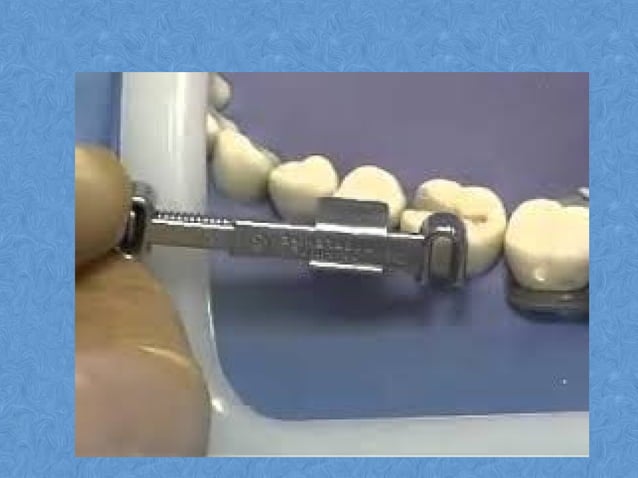 Types Of Matrix Retainer & Parts Of Retainer | PPT | Dental Health ...