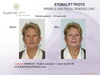 SYGMALIFT FACIAL CONTOURING | PDF