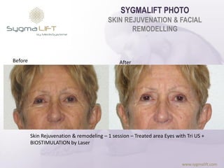 SYGMALIFT FACIAL CONTOURING | PDF