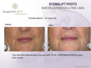 SYGMALIFT FACIAL CONTOURING | PDF