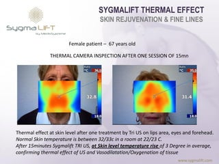 SYGMALIFT FACIAL CONTOURING | PDF