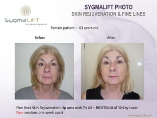 SYGMALIFT FACIAL CONTOURING | PDF
