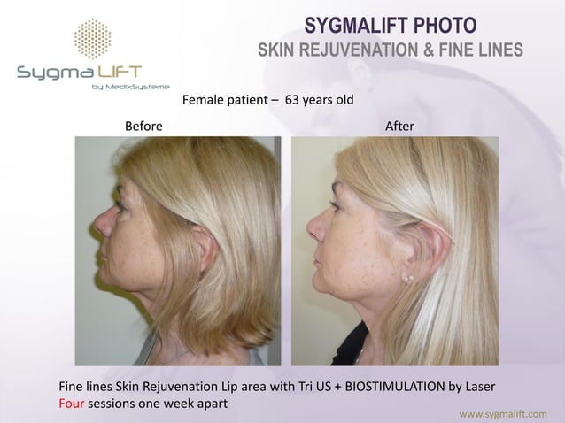 SYGMALIFT FACIAL CONTOURING | PDF
