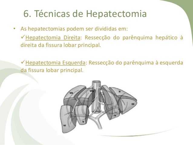 Hepatectomia