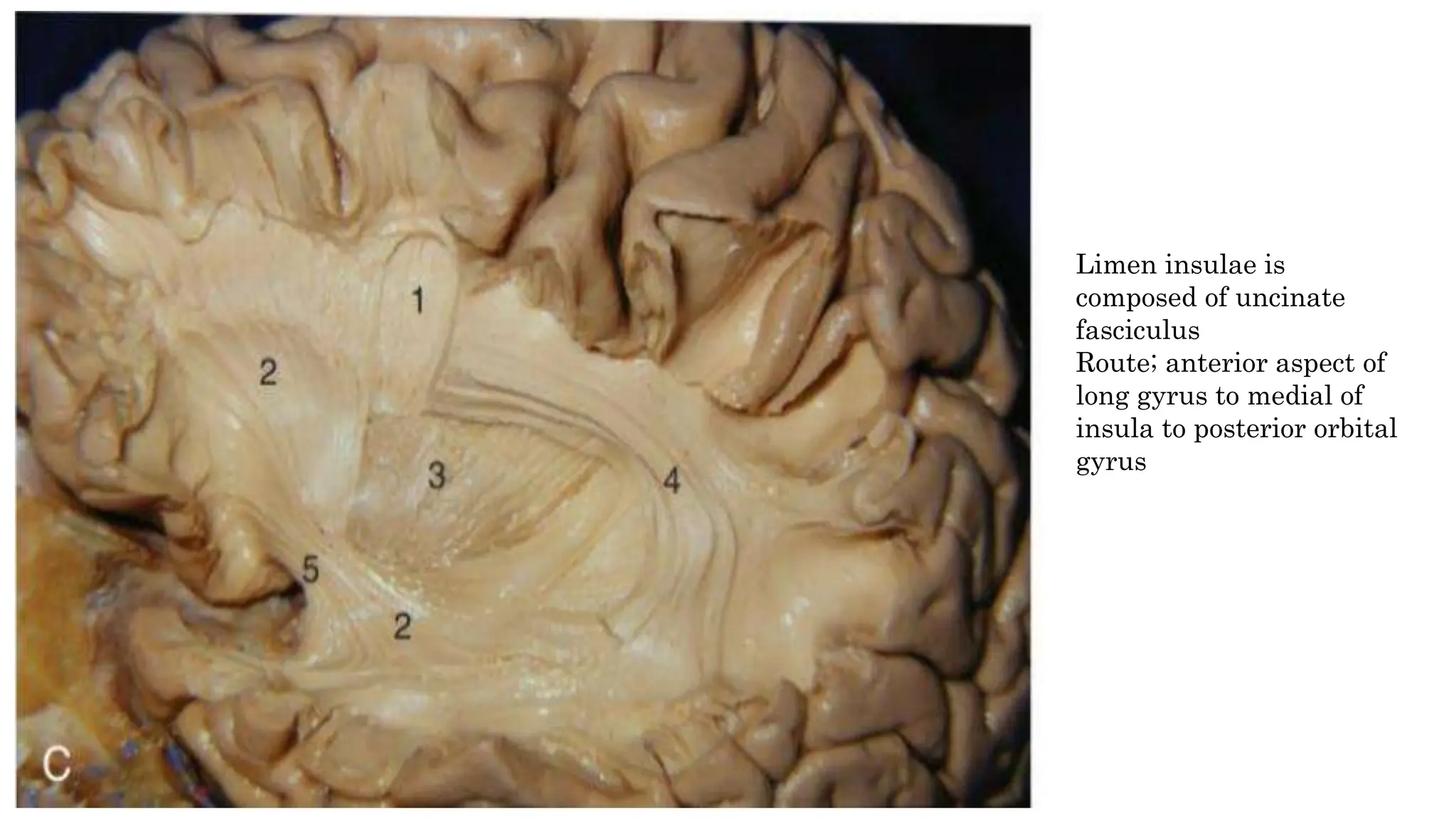 Sylvain fissure Neuro surgical Anatomy and corridors | PPTX