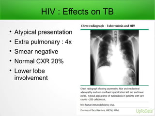 TB plus HIV | PPT