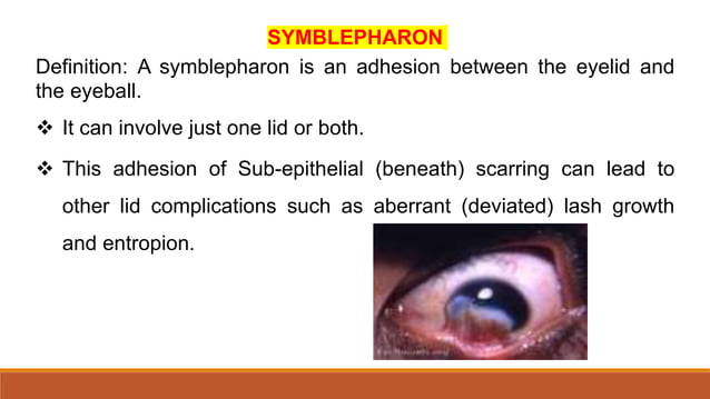 symblephoron types etiology management.pptx | Eye and Vision Conditions ...