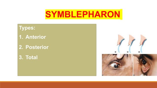 symblephoron types etiology management.pptx | Eye and Vision Conditions ...
